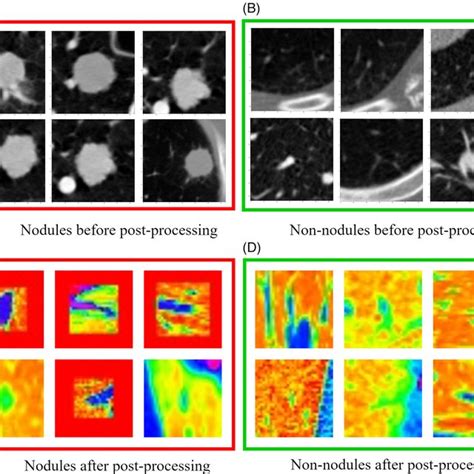 Schematic Overview Of The Proposed Model For Lung Nodule Detection