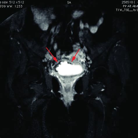 Pdf Encrusted Cystitis Caused By Corynebacterium Urealyticum A Case Report With Novel
