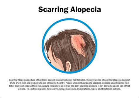 Scarring Alopecia Symptoms Causes Treatment And Prevention Richfeel