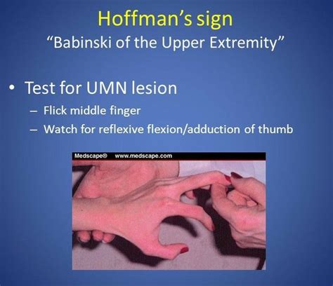 Hoffman Sign