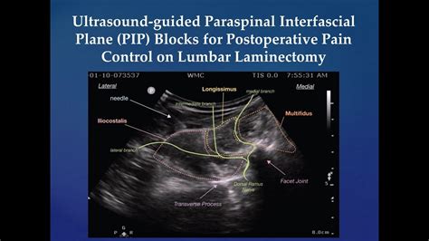 Ultrasound Guided Paraspinal Interfascial Plane Pip Blocks For Lumbar Laminectomy Youtube