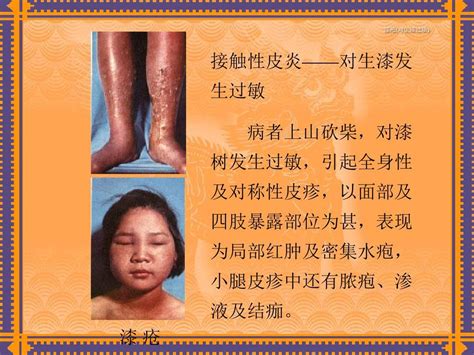 第九节 接触性皮炎 word文档在线阅读与下载 免费文档
