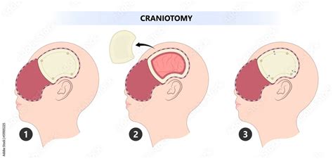 Brain Cancer Tumor And Burr Hole Skull Bone Flap Fluid Head Post Sport