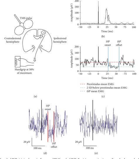 Figure 1 From Interhemispheric Pathways Are Important For Motor Outcome