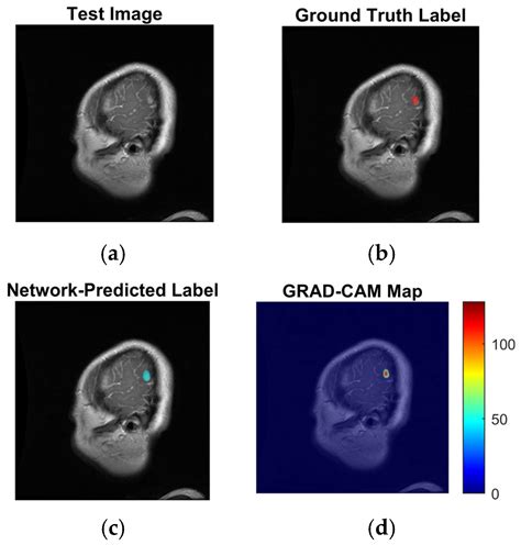 Improved Brain Tumor Segmentation In Mr Images With A Modified U Net