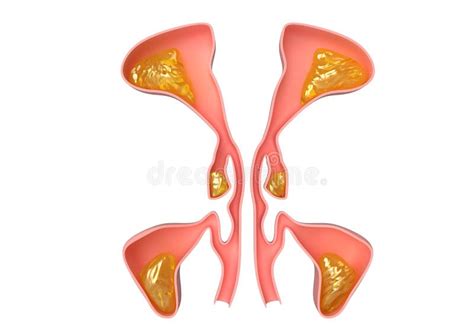 Nasal Sick Stock Illustrations 2399 Nasal Sick Stock Illustrations