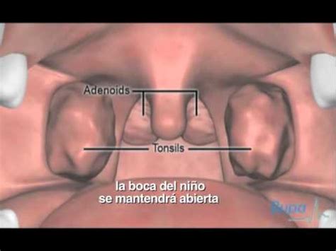 Extracci N De Adenoides Y Am Gdalas Youtube