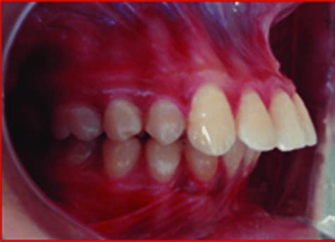 Evaluation Of Occlusal Relationships At Centric Occlusion Download