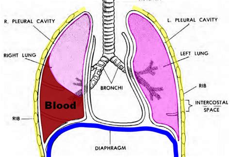 Hemothorax Causes Signs Symptoms Diagnosis And Hemothorax Treatment