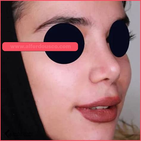 المواصفات والسعر وحجز موعد تجميل الأنف الدكتور محمد امين فخري نيا