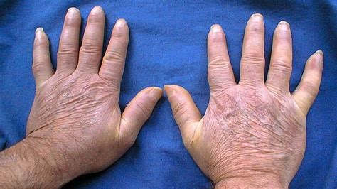 National Scleroderma Foundation On Linkedin Autoantibodies Could Help