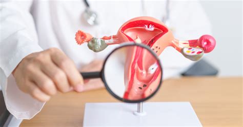 Homeopathy Medicines For Fibroid Dr Pratibha Tanwar