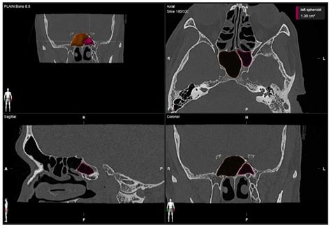 Volumetric Measurement Of The Right And Left Sphenoid Sinus Download
