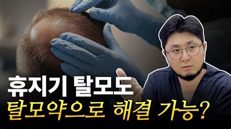 갑자기 찾아온 휴지기 탈모 어떻게 극복해야 할까 Youtube