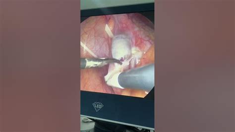 Criptoquirdia Testículo Não Descido Na Bolsa O Tratamento é Com A