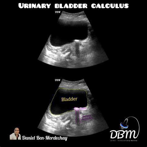 Ultrasound Pocus Radiology Sonography Diagnosis Imagine Bladder