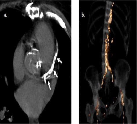 Figure 1 From Aortic Stenosis And Vascular Calcifications In
