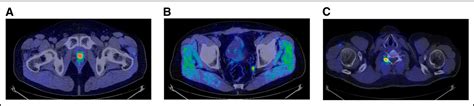 Figure 1 From 11c Or 18f Choline Petct For Imaging Evaluation Of