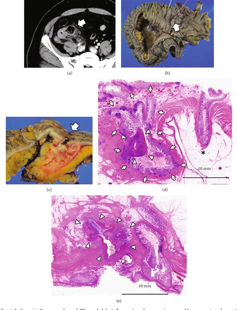Figure 1 From Penetration And Perforation Of Terminal Ileum
