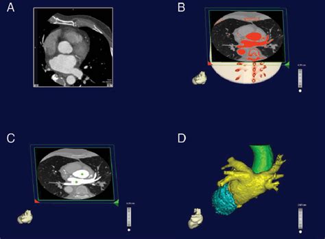 segmentation of a computed tomography ct dataset for image