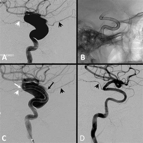 8 Best Coiling Ped Stents For Cerebral Aneurysms Images On Pinterest Medical Devices