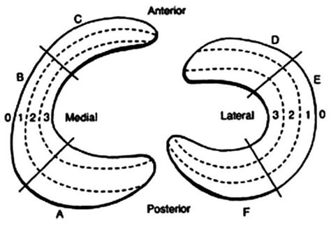 Zone Classification Of The Meniscus Posterior Third Zone Of