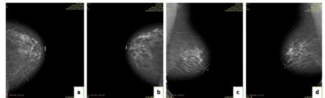 Some Examples Of Bi Rads 3 A Cc View Of The Left Breast