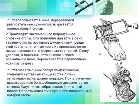 Костно пластическая ампутация голени по Пирогову презентация онлайн