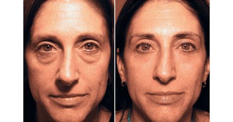 Innovating Eyelid And Facial Rejuvenation An Interview With Dr Adam