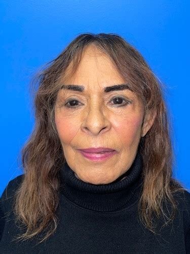 Facelift Newport Beach California Plastic Surgery Clinic