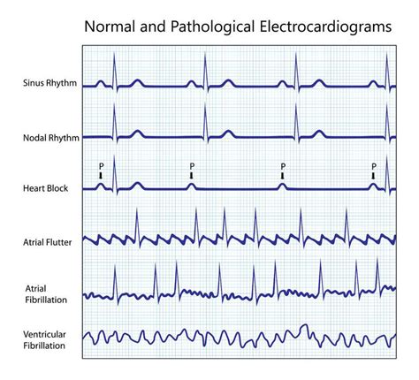 Atrial Flutter Cardiology Highland Hospital University Of Rochester Medical Center