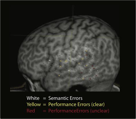 Preoperative Language Mapping Using Navigated Tms Compared With Extra Operative Direct Cortical