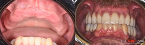 Replace Upper Denture With Implants Smile Gallery