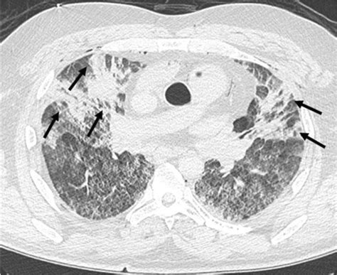 Post Mortem Computed Tomography Pmct Showing Diffuse Bilateral Download Scientific Diagram