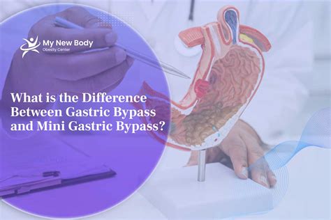 What Is The Difference Between Mini Gastric Bypass And Gastric Bypass