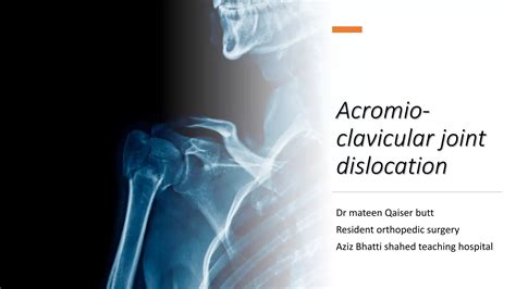 Ac Joint Dislocation Pptx