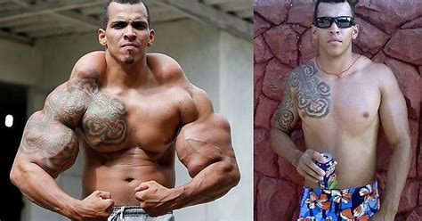 Body Builder Almost Died After Getting Synthol Injections Imgur