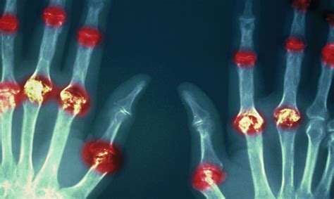 Ρευματοειδής αρθρίτιδα Συμπτώματα διαθέσιμες θεραπείες και μέτρα πρόληψης