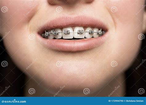 Beautiful White Teeth With Braces Dental Care Photo Woman Smile With