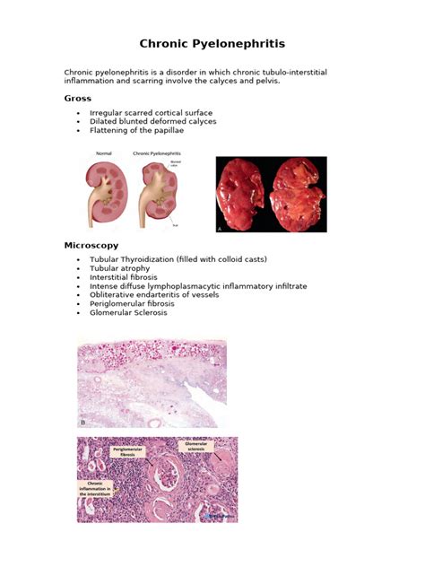 Renal Chronic Pyelonephritis Pdf