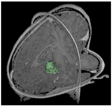 This Image Presents The D Segmentation Result Of Growcut Green For