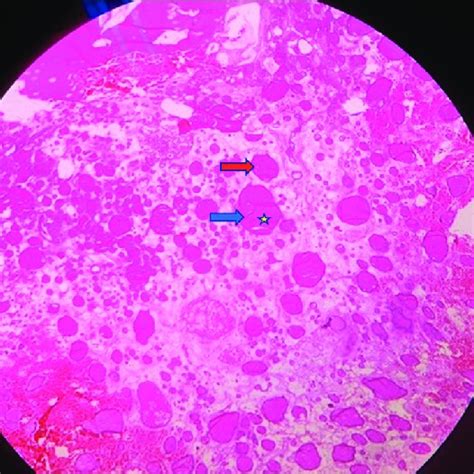 H And E ×40 Showing Numerous Thyroid Follicles Of Varying Size With