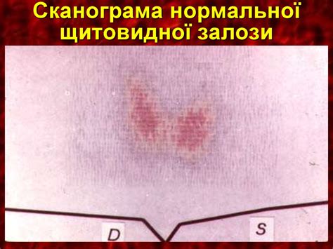Захворювання щитоподібної залози презентация онлайн