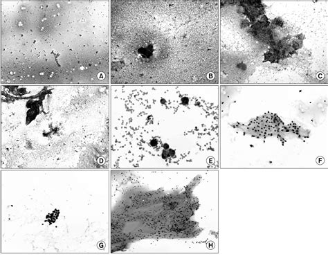 Figure 1 From Fine Needle Aspiration Cytology Of Thyroid Follicular