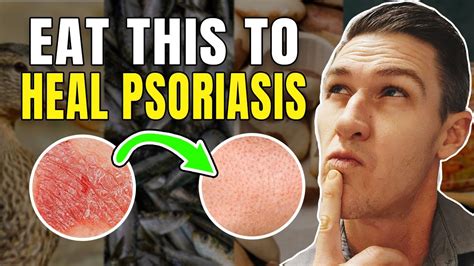 5 Foods To Eat If You Have Psoriasis How To Treat Psoriasis Youtube
