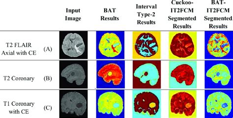 Segmentation Of Primitive Neuro Ectodermal Tumor Pnet Region In The Download Scientific