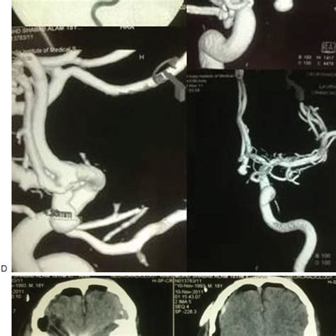 Second Case Axial Ct Images Show Right Frontotemporal Subdural