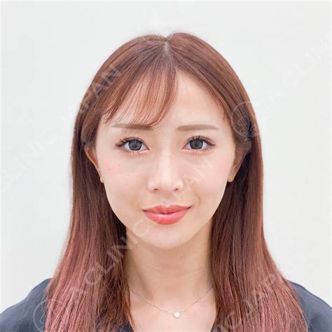 口横のもたつきにもアプローチ！aスレッドの処置前と処置直後の症例です30代女性 美容整形クリニックa Clinic【公式】
