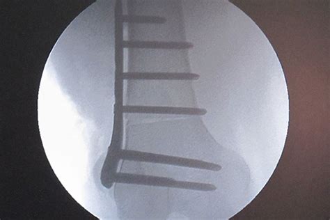 Home Complex Cases Varising Derotational Distal Femoral Osteotomy