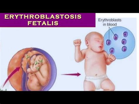 Erythroblastosis Fetalis Meaning Erythroblastosis Fetalis Causes